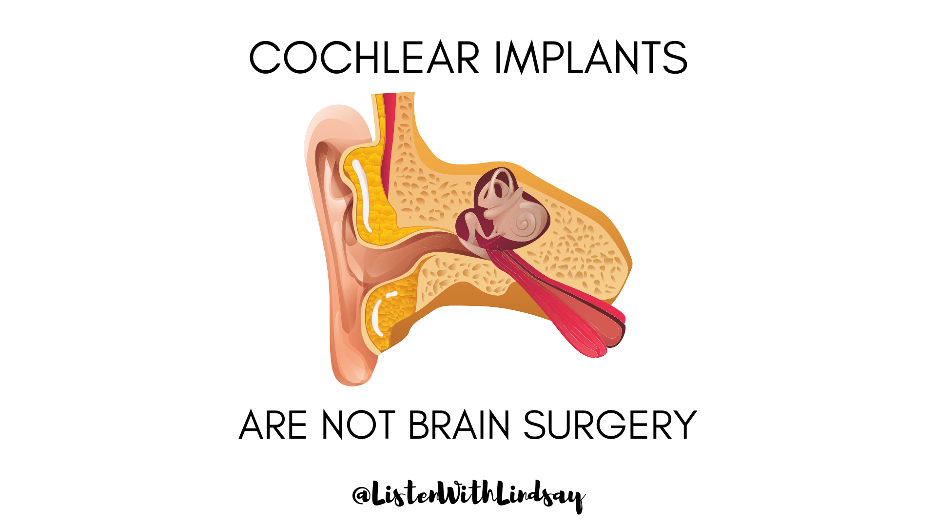 Are Cochlear Implants Brain Surgery? – Listen With Lindsay